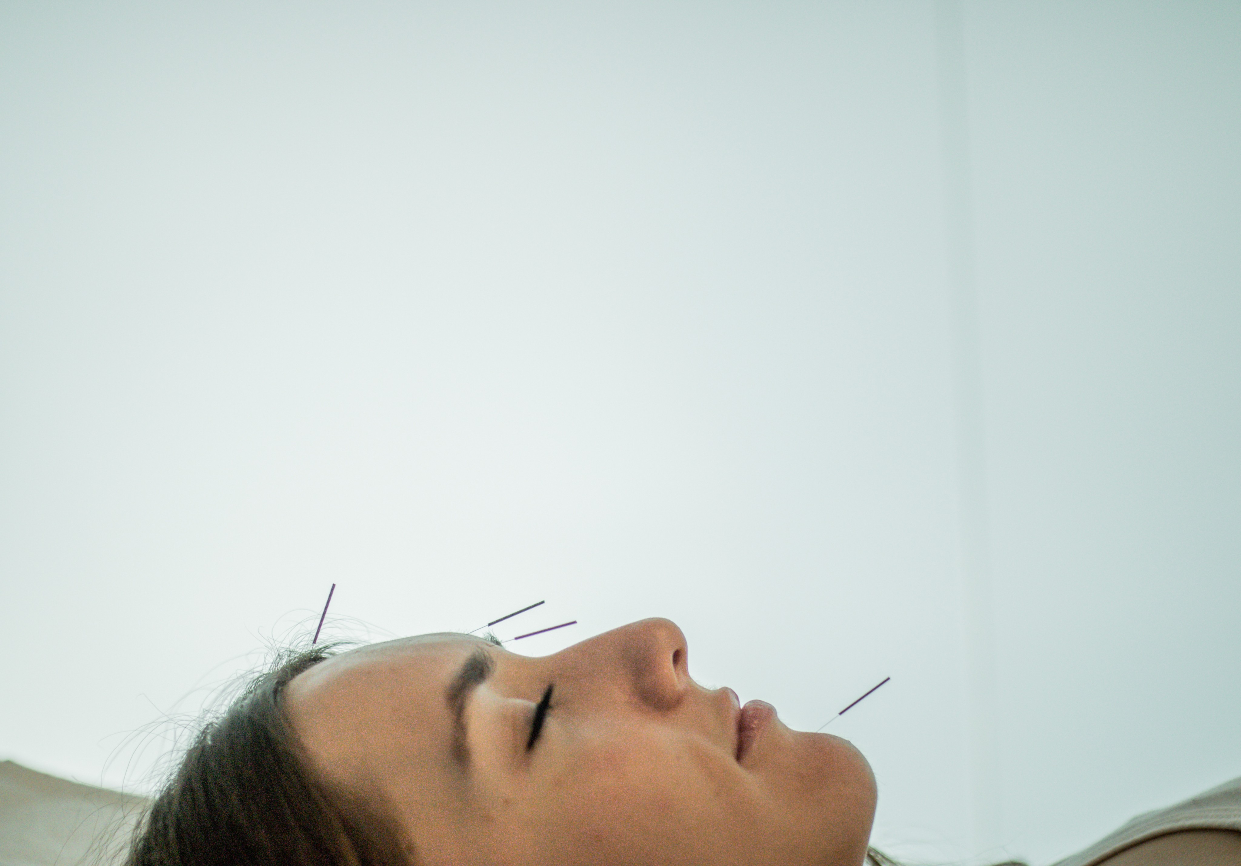 Acupuncture Can Assist With Chronic Pain: A Holistic Approach to Healing